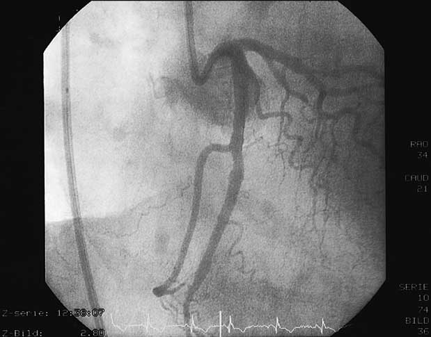 The MSM-BMS Coronary Stent